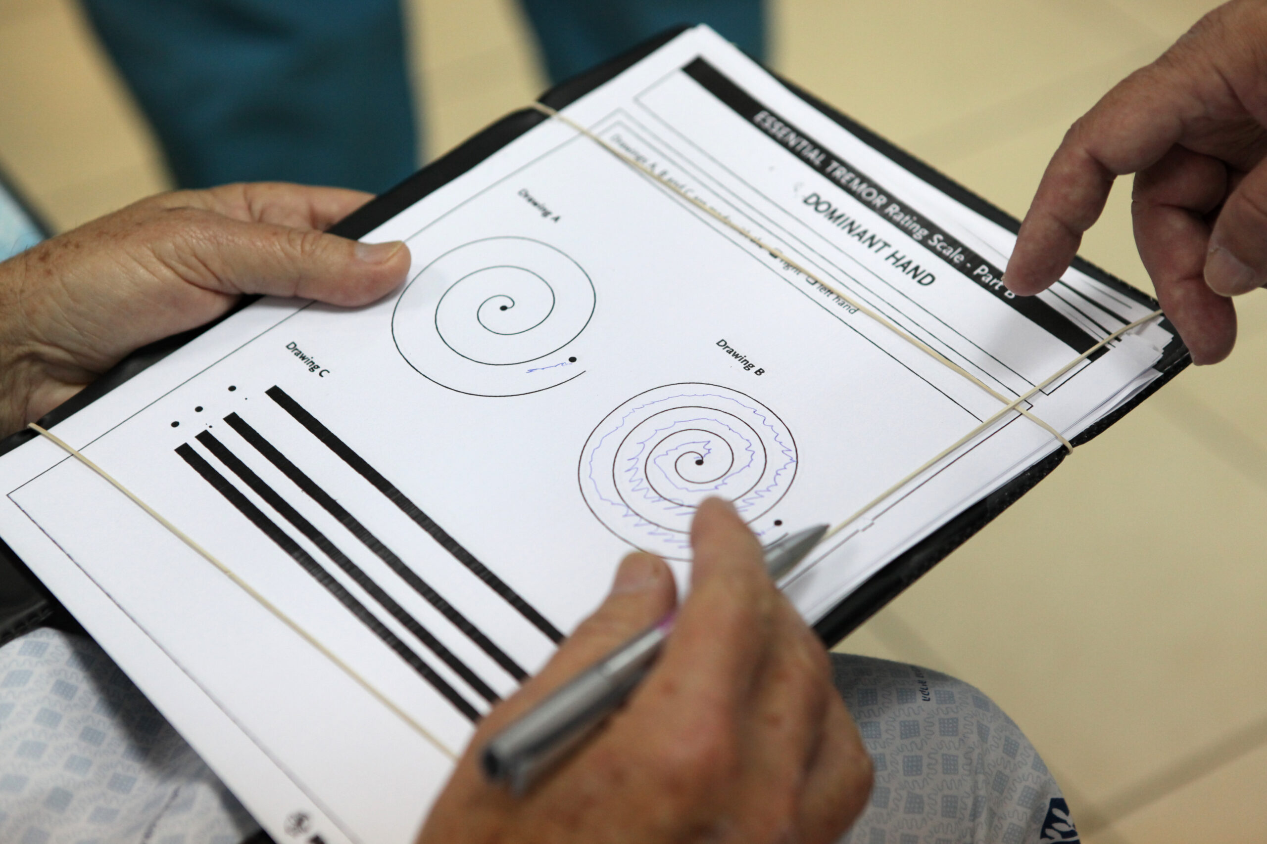 Spiral drawings to evaluate patient progress before and after treatment ...